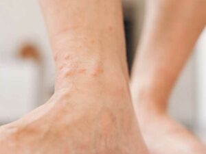 Quelles causes des points rouges sur les jambes et comment se soigner